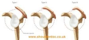 4 Shoulder Impingement Tests to Differentiate from AC Joint Injury ...