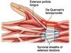 How to Treat and Prevent De Quervain's Tenosynovitis - Precision Movement