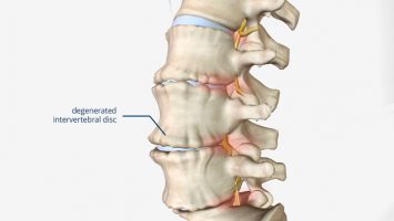 How to STOP Disc Degenerative "Disease" (Exercises & Tips)