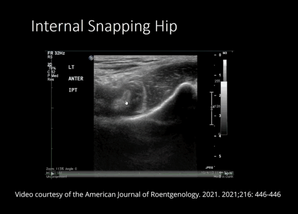4 Snapping Hip Syndrome Exercises (Plus Psoas Strengthening)