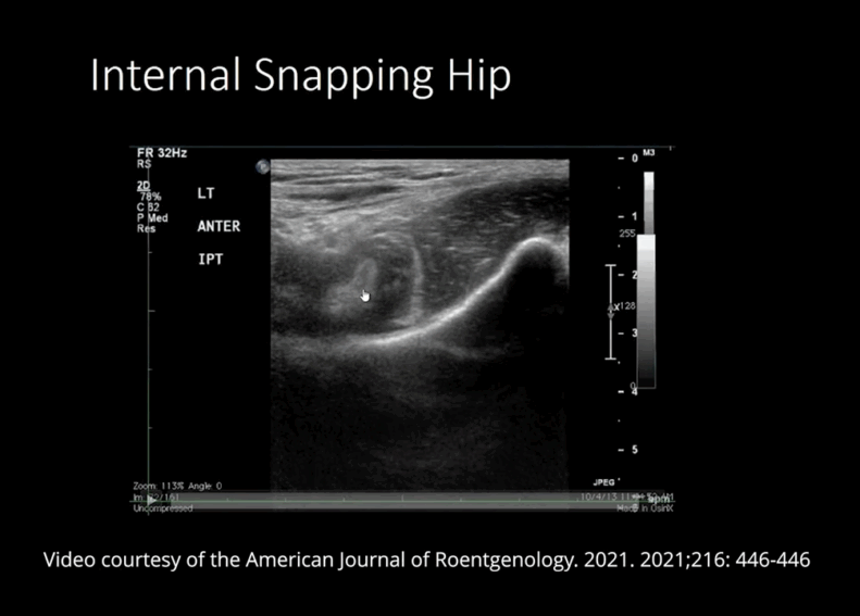 4 Snapping Hip Syndrome Exercises (Plus Psoas Strengthening)